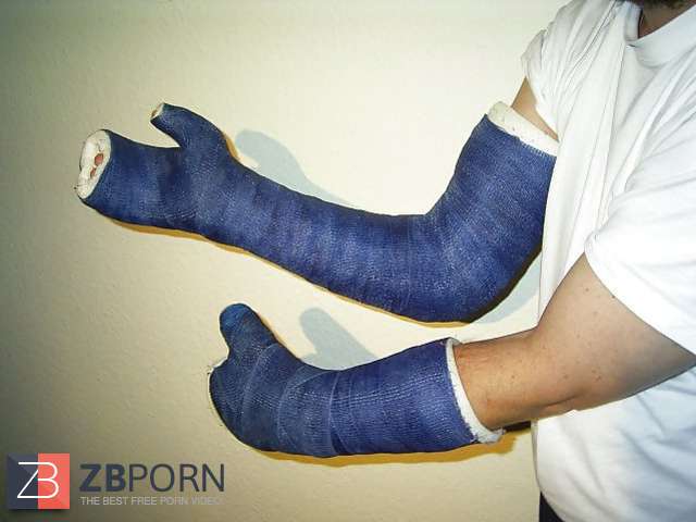 Gips Cast Zb Porn
